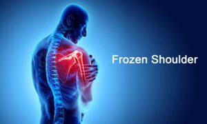 Relieving the Freeze: How Shockwave Therapy Helps Frozen Shoulder | R ...